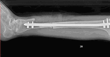 Nonunions | SIGN Fracture Care